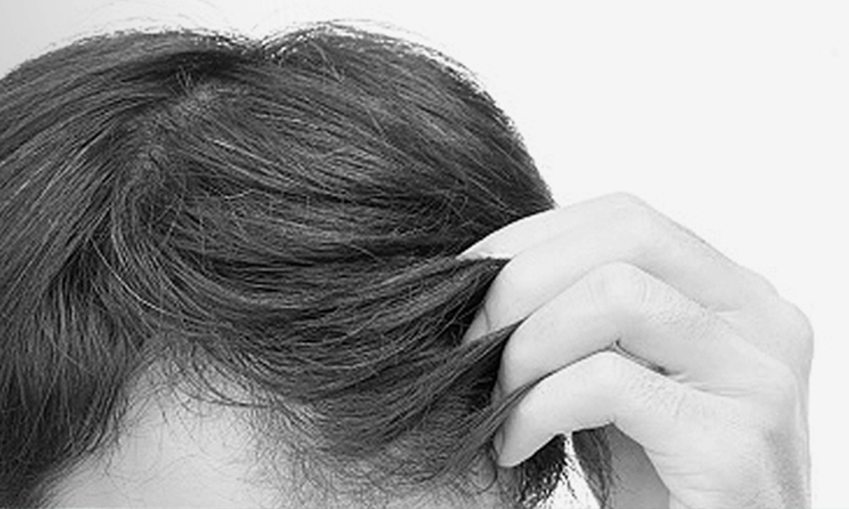 How NeoGraft Hair Transplant Works | NeoGraft Dallas